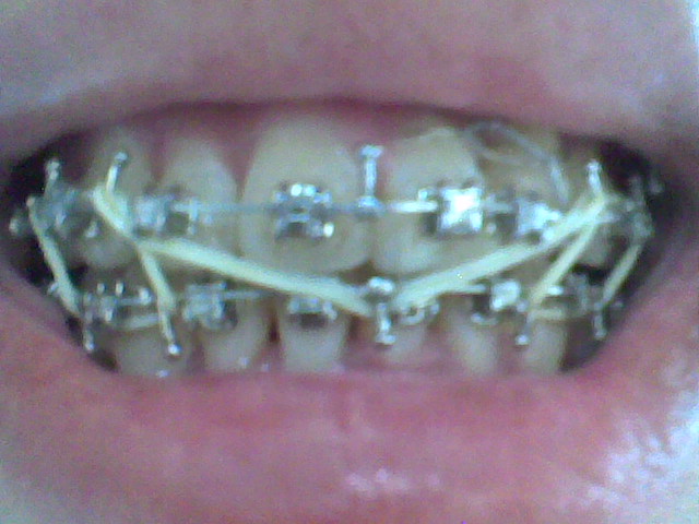 Day 9 post op - Rabbit and Penguin rubber bands .j Picture